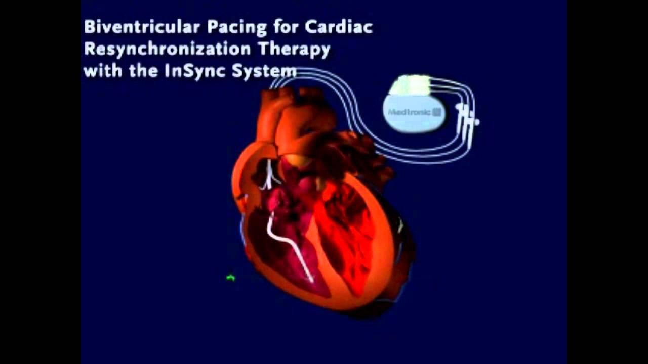 The Goal of Cardiac Resynchronization - YouTube
