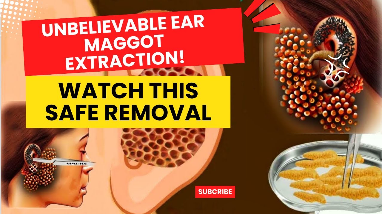 Unbelievable Ear Maggot Extraction! 😱 Watch This Safe Removal! - YouTube