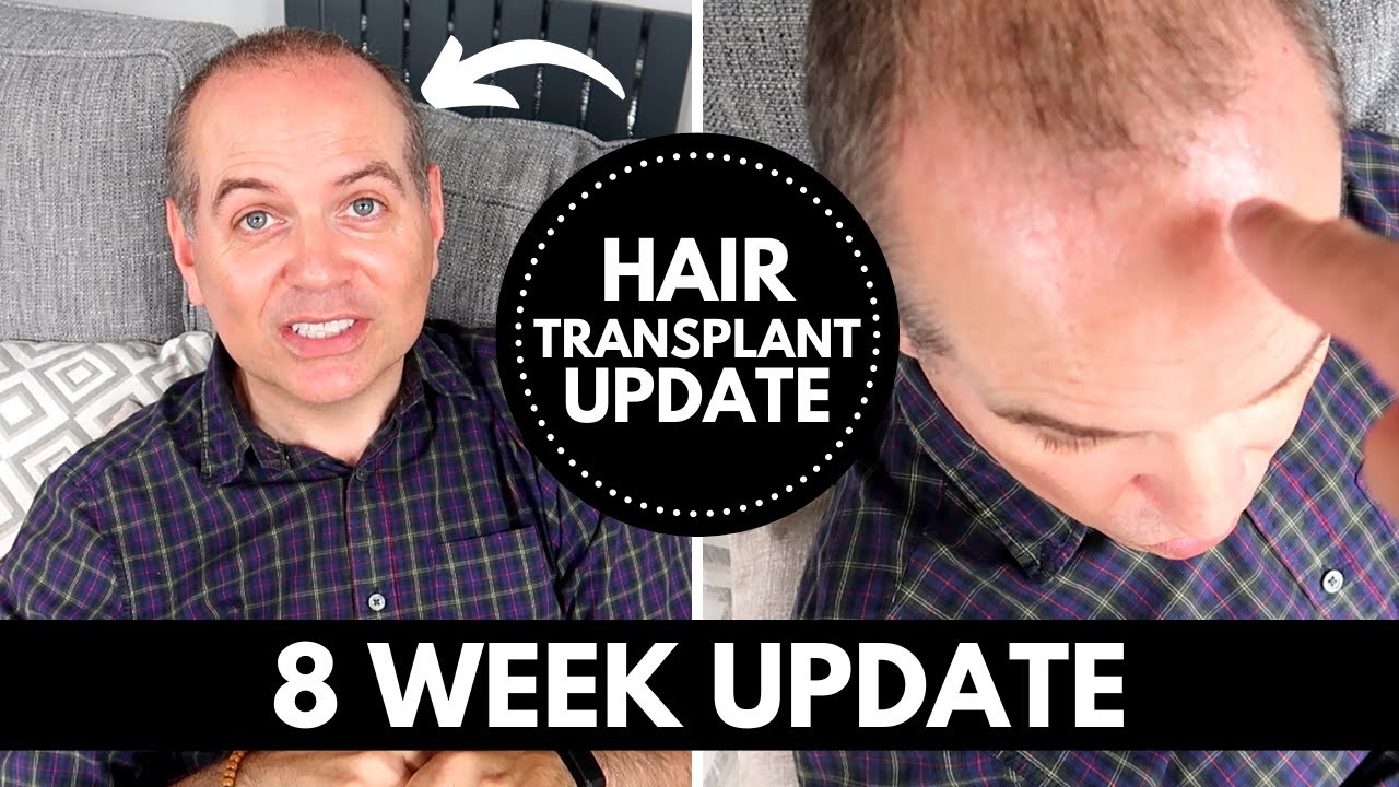 IS THE HAIR TRANSPLANT WORKING ? | 8 WEEK UPDATE - YouTube