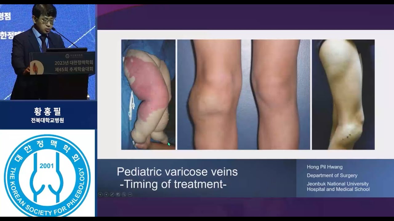 Pediatric varicose veins - Timing of treatment - YouTube