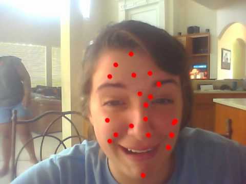 Crazy chicken pox! - YouTube