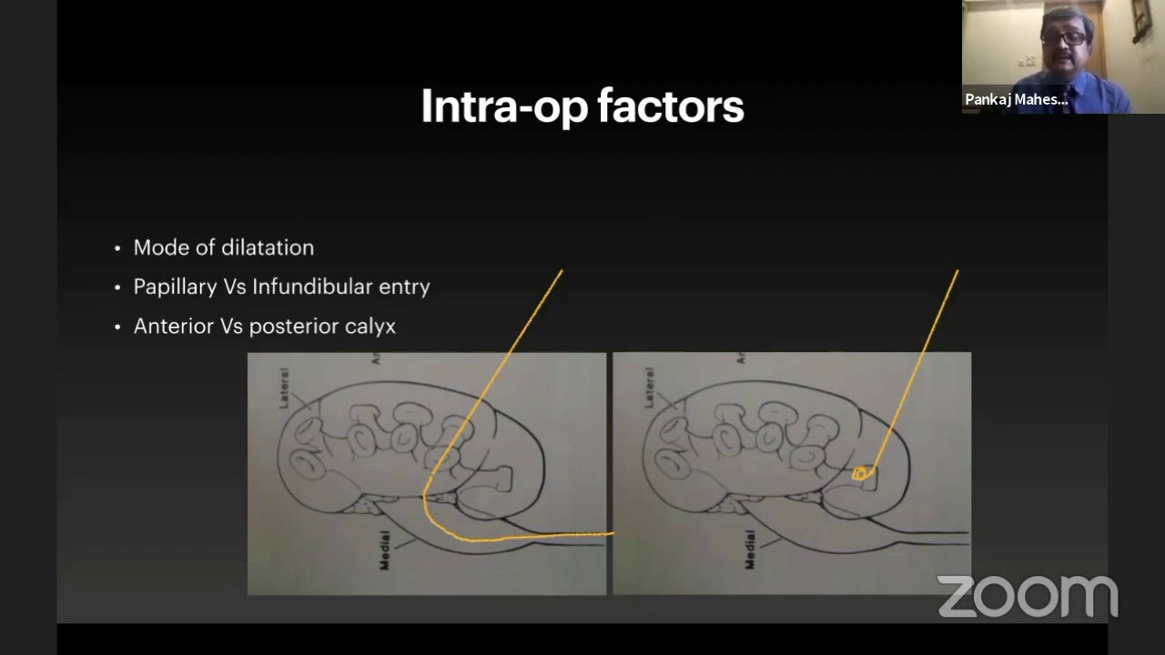 Bleeding During & After PCNL || Urology || - YouTube