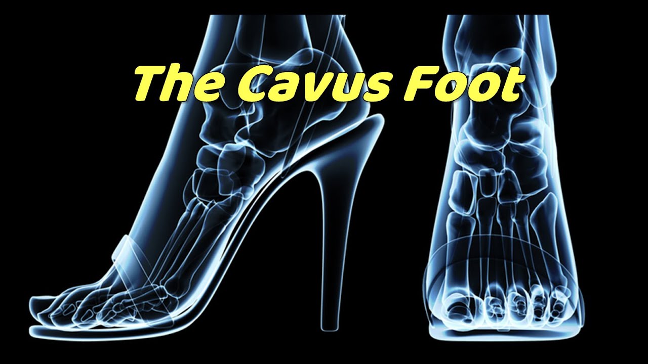 Cavus Foot: The Work Up, Evaluation, and Treatment - YouTube
