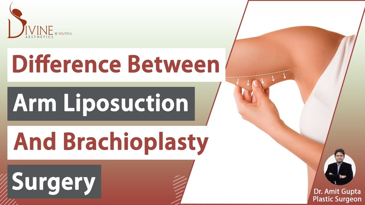 Difference Between Arm Liposuction And Brachioplasty Surgery Divine difference-between-arm-liposuction-and-brachioplasty-surgery-divine