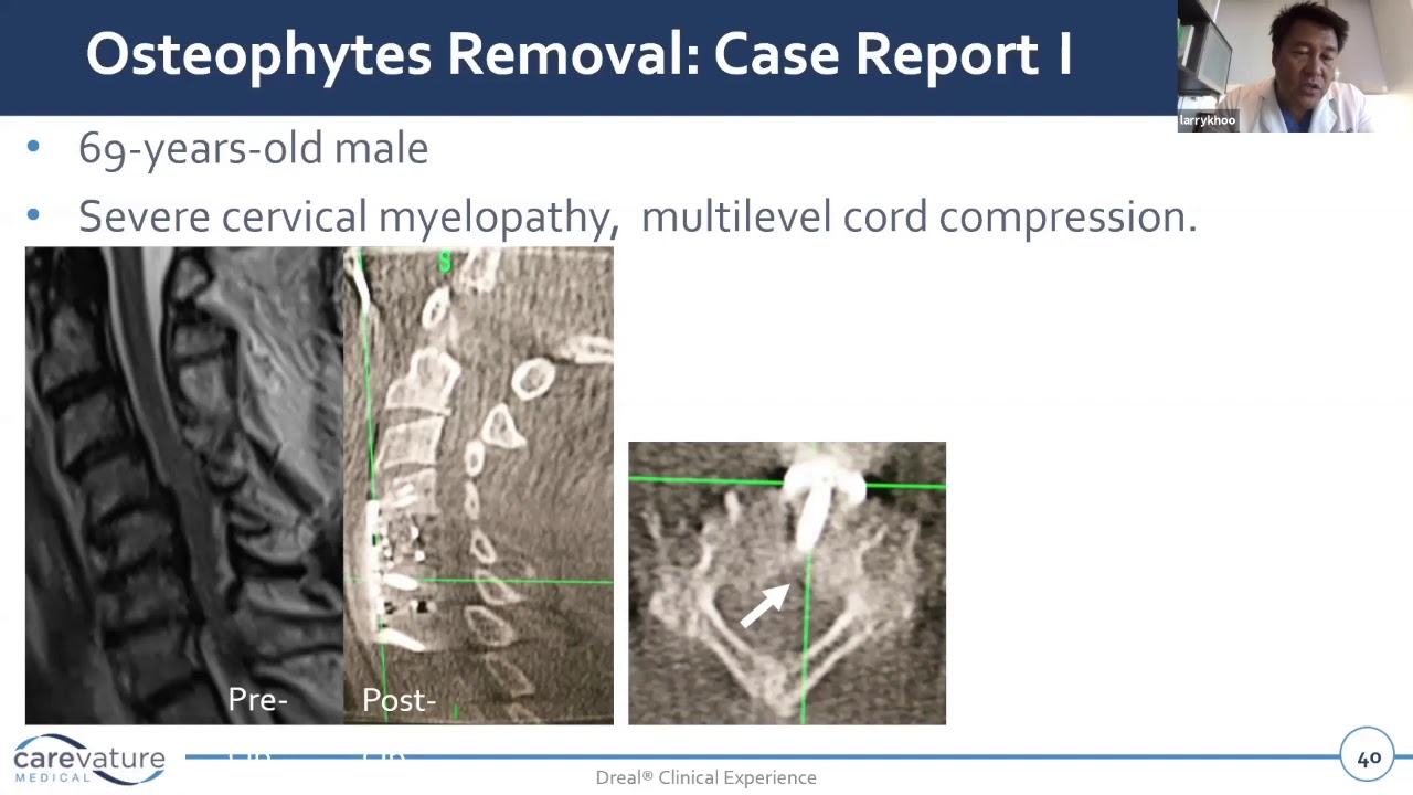 Larry Khoo, MD - Cervical Corpectomy Case Review - YouTube