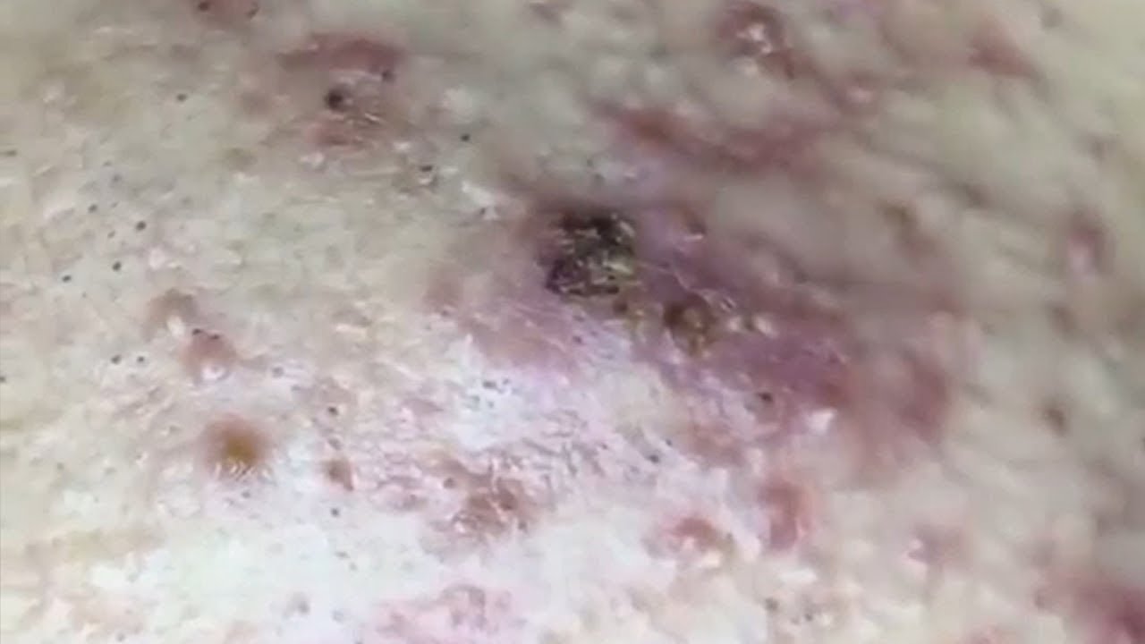 Subcutaneous acne for many years | 수년간 피하 여드름 | Подкожные прыщи на ...