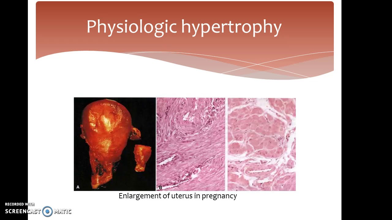 Hyperplasia , Hypertrophy , Atrophy and Metaplasia - Deciphering these ...