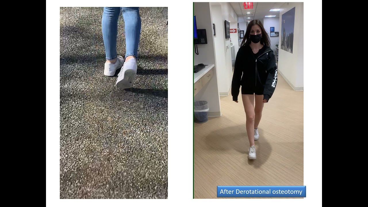 Dr. Rozbruch discusses treatment of excessive femoral anteversion or in ...