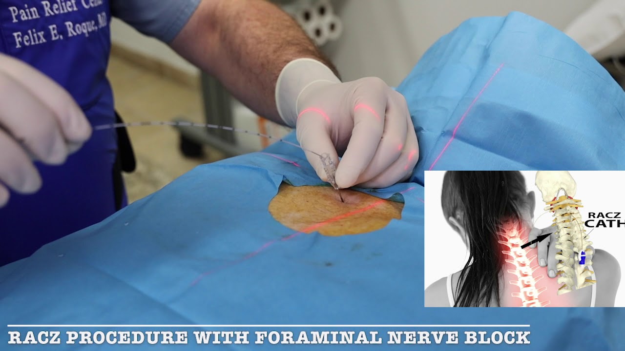 Racz procedure with Foraminal Nerve Block, A 11 7 18 - YouTube