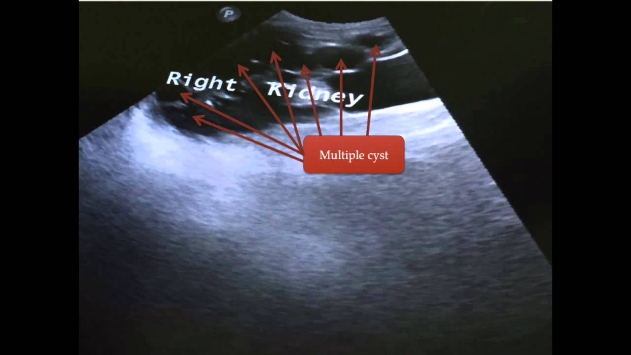 Polycystic Kidney Ultrasound