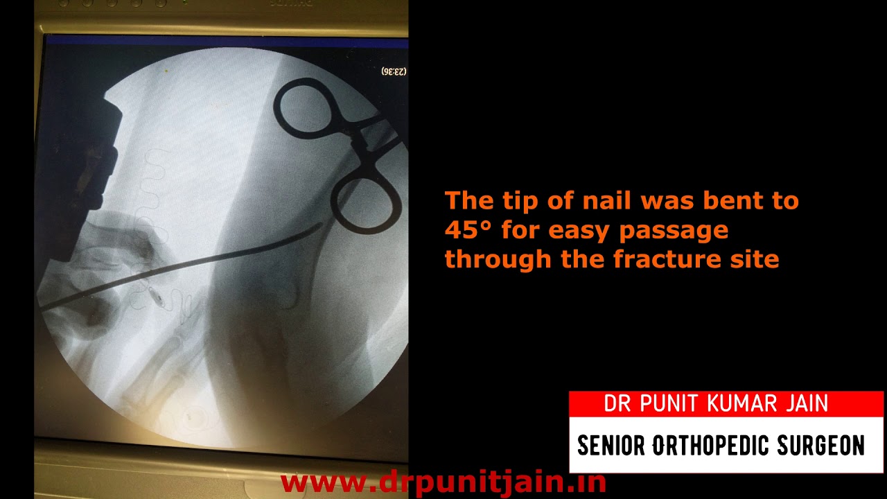 Titanium Elastic Nailing in Pediatric Fracture Humerus - YouTube