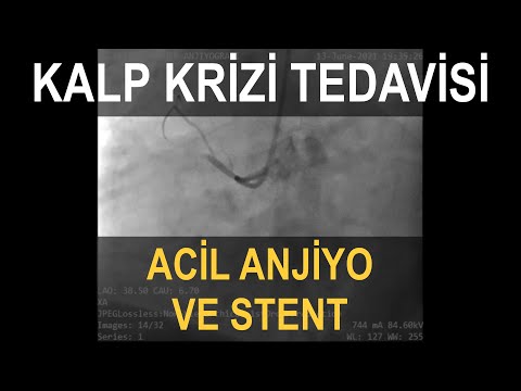 KALP KRİZİ TEDAVİSİ | Acil Anjiyo ve Stent