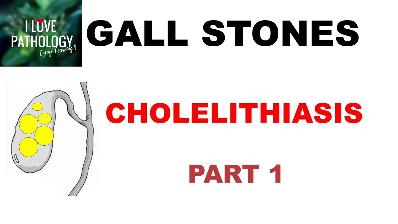 CHOLELITHIASIS/ GALL STONES-Part 1: Epidemiology, Types, Risk factors ...
