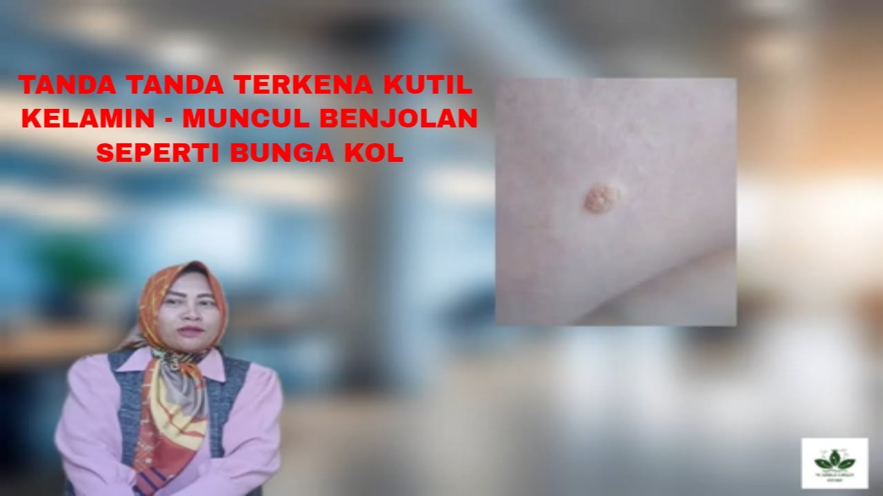 TANDA TANDA TERKENA KUTIL KELAMIN - MUNCUL BENJOLAN SEPERTI BUNGA KOL ...