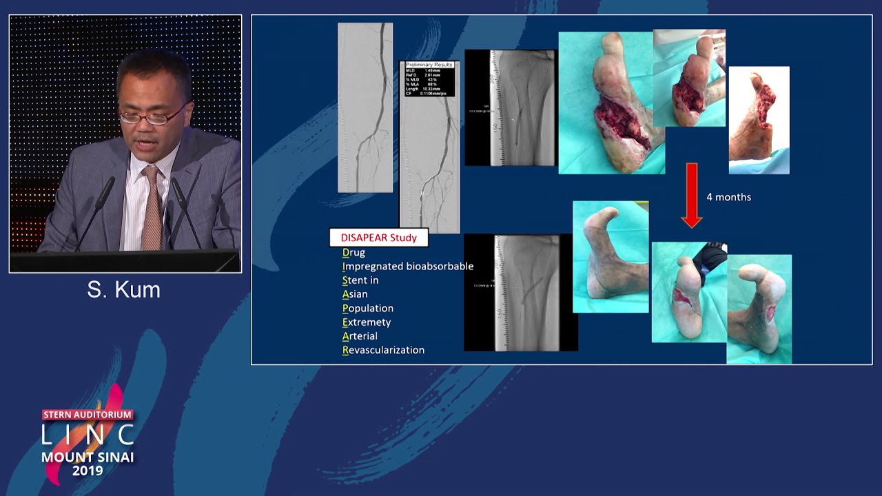 Stern D2 - Bioabsorbable Vascular Scaffold (BVS) for CLI; DISAPEAR ...