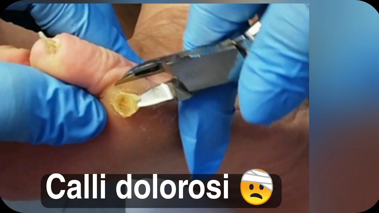 Calli dolorosi sotto la pianta del piede! Tutorial passo a passo - YouTube