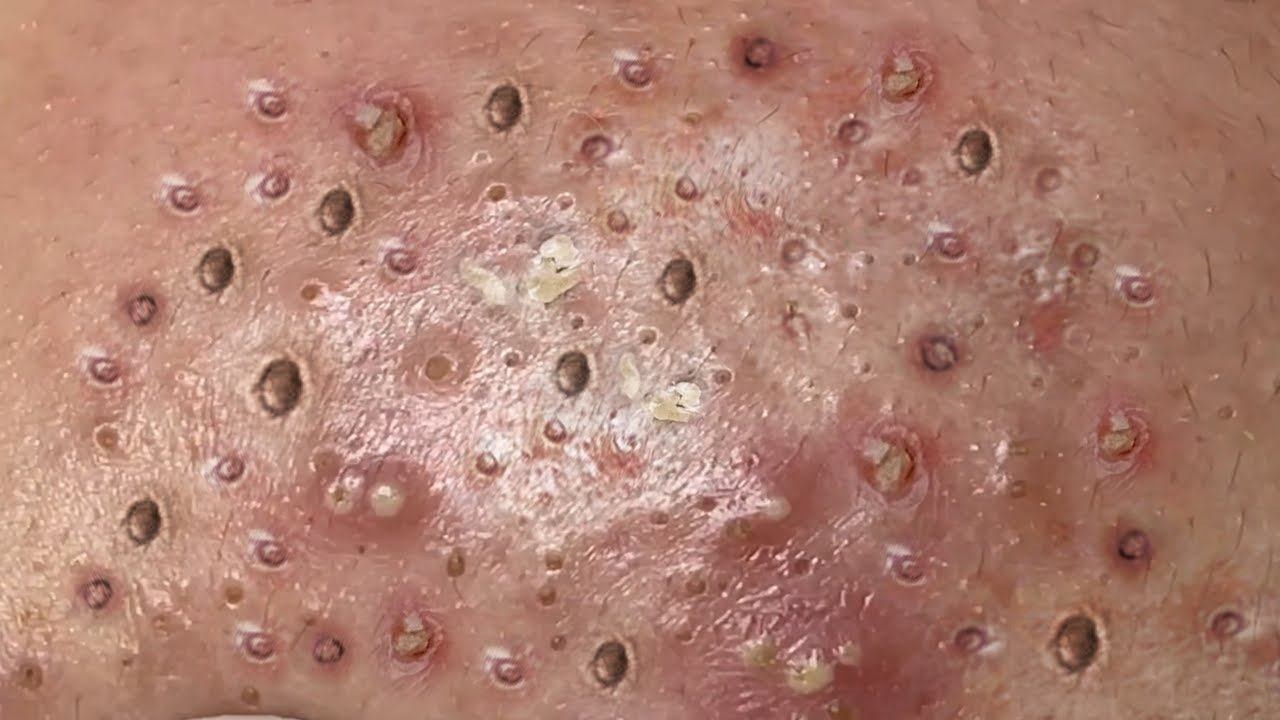 Loan Nguyen Acne Treatment 70x - YouTube