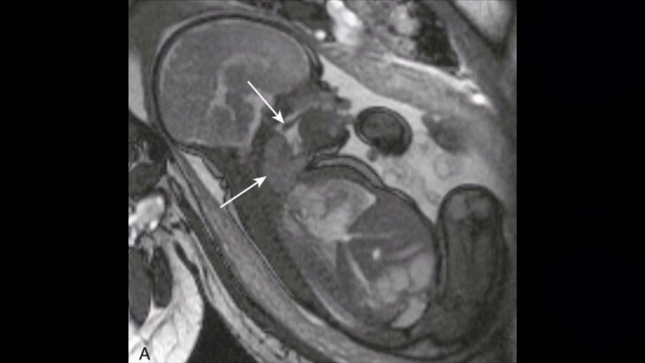 Fetal or neonatal goiter - YouTube