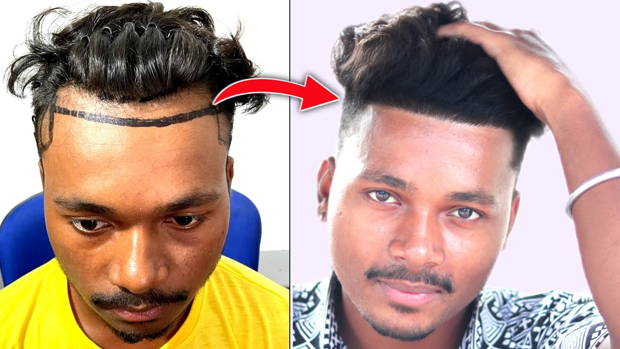 0 To 7 Months Hair Transplant Result | Hair Transplant Result | Before After Hair Transplant ...