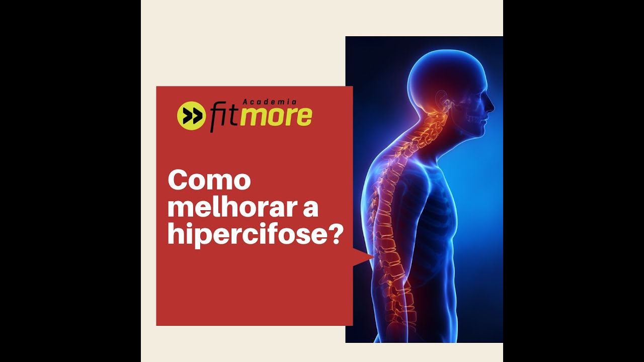 Como melhorar a hipercifose? - YouTube