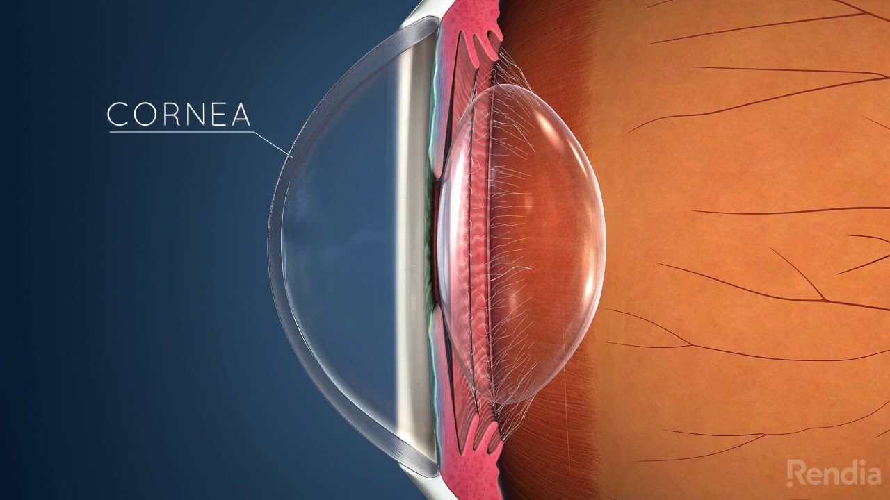 Myopia Overview - YouTube