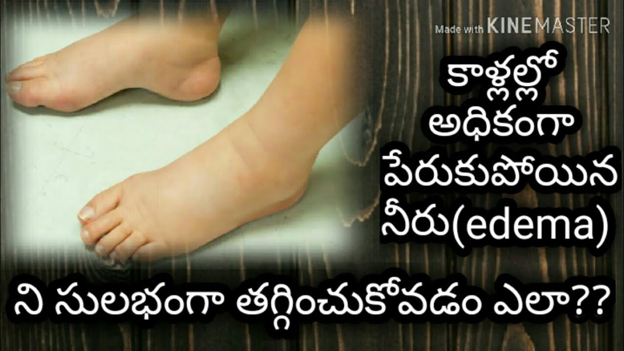 Legs Swelling Causes And Ayurvedic Treatments In Telugu YouTube Legs Swelling Causes And Ayurvedic Treatments In Telugu YouTube