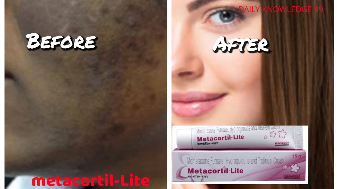 metacortil-Lite #fairness skin how to use metacortil-Lite and unboxing ...