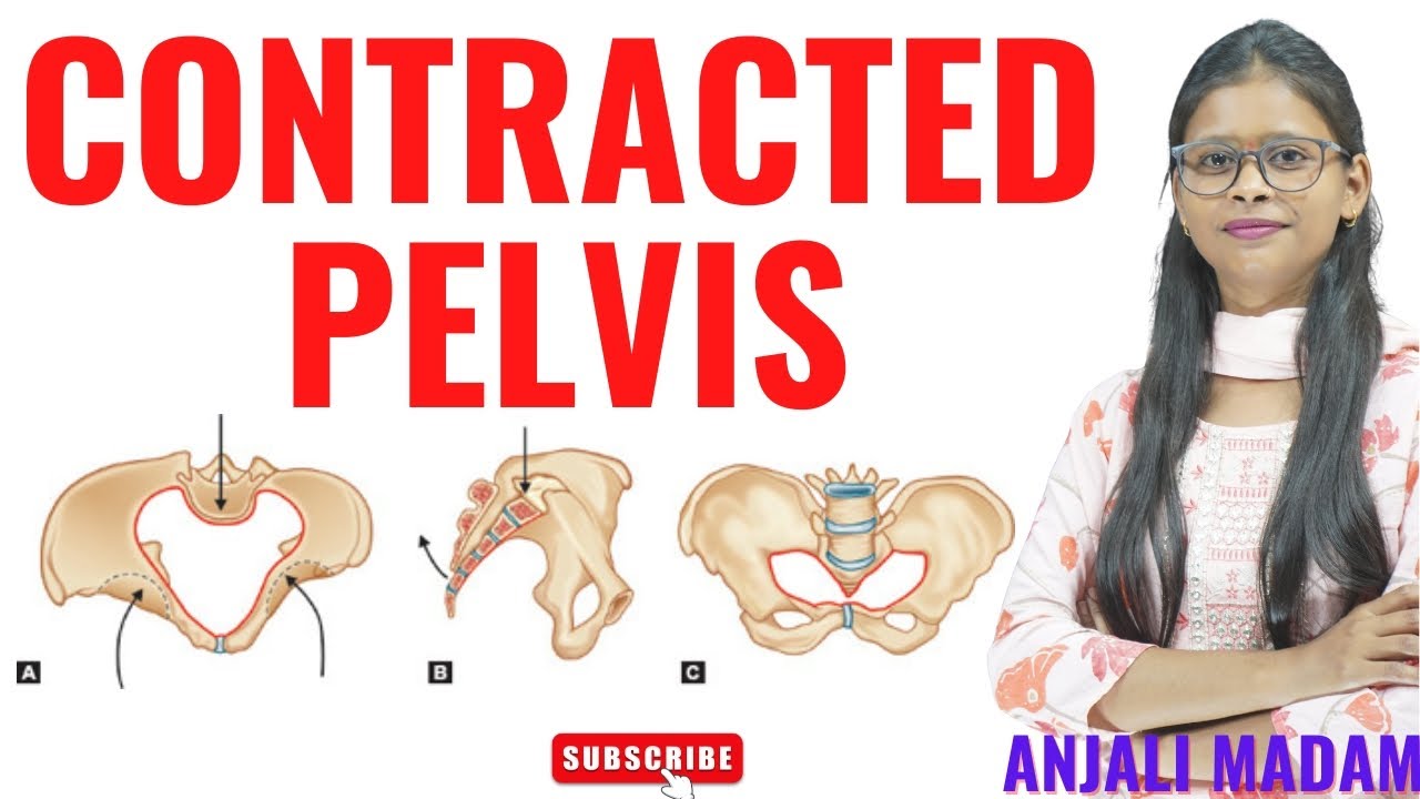 Contracted Pelvis II Midwifery and Gynaecological Nursing II Anjali Mam ...