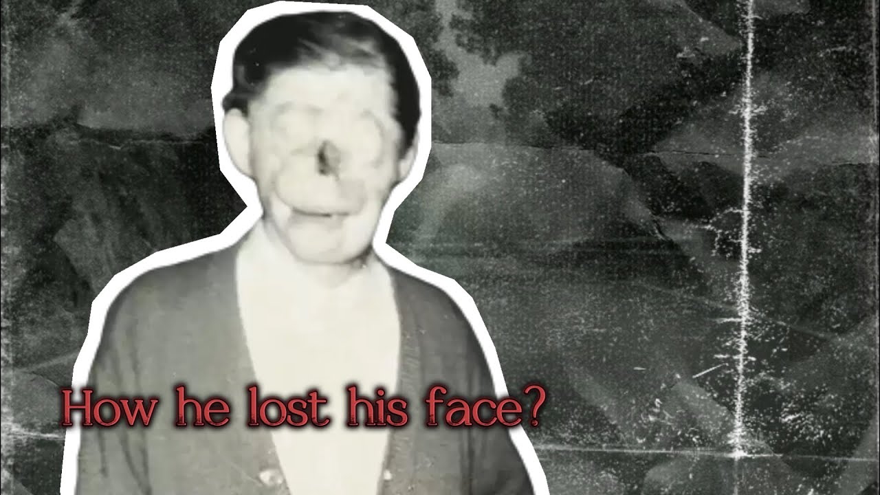 A man who lost his face | Charlie no face | Mystery - YouTube