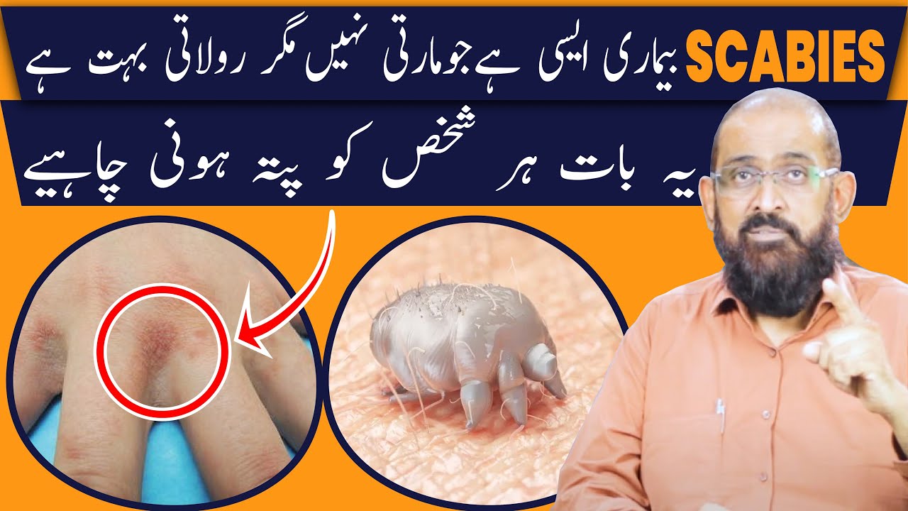 Scabies Medicine Lotion (Shadeed Kharish ka ilaj) Scabies Causes and ...