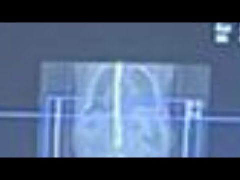 Spinal cord injury Ventilation Home Sleep Study #nippy4 #ventilators # ...