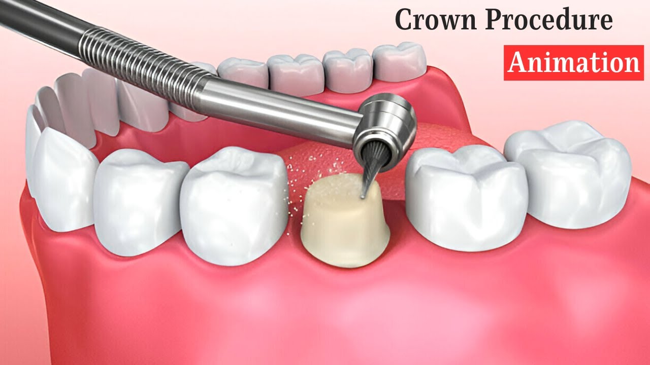 Dental Crown Procedure: Restoring Your Smile with Confidence - YouTube