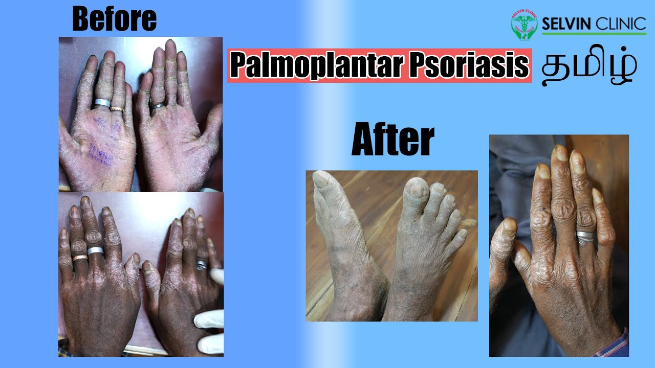 Palmar Plantar Psoriasis