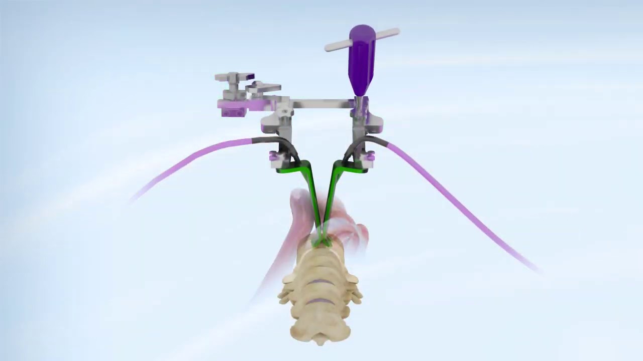 Phantom CS Pivoting Retractor - YouTube