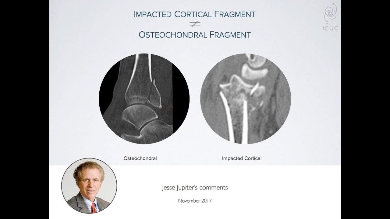 Impacted cortical fragment in DRF - YouTube