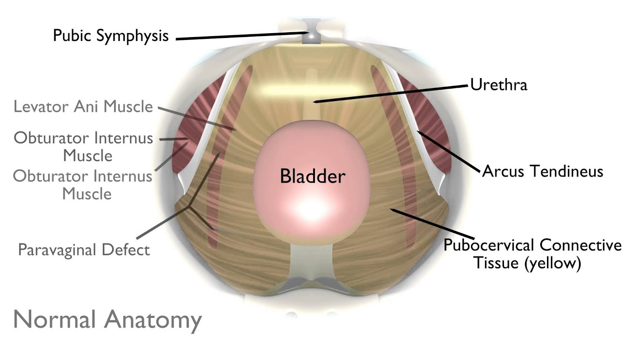 Paravaginal Defect Repair - YouTube