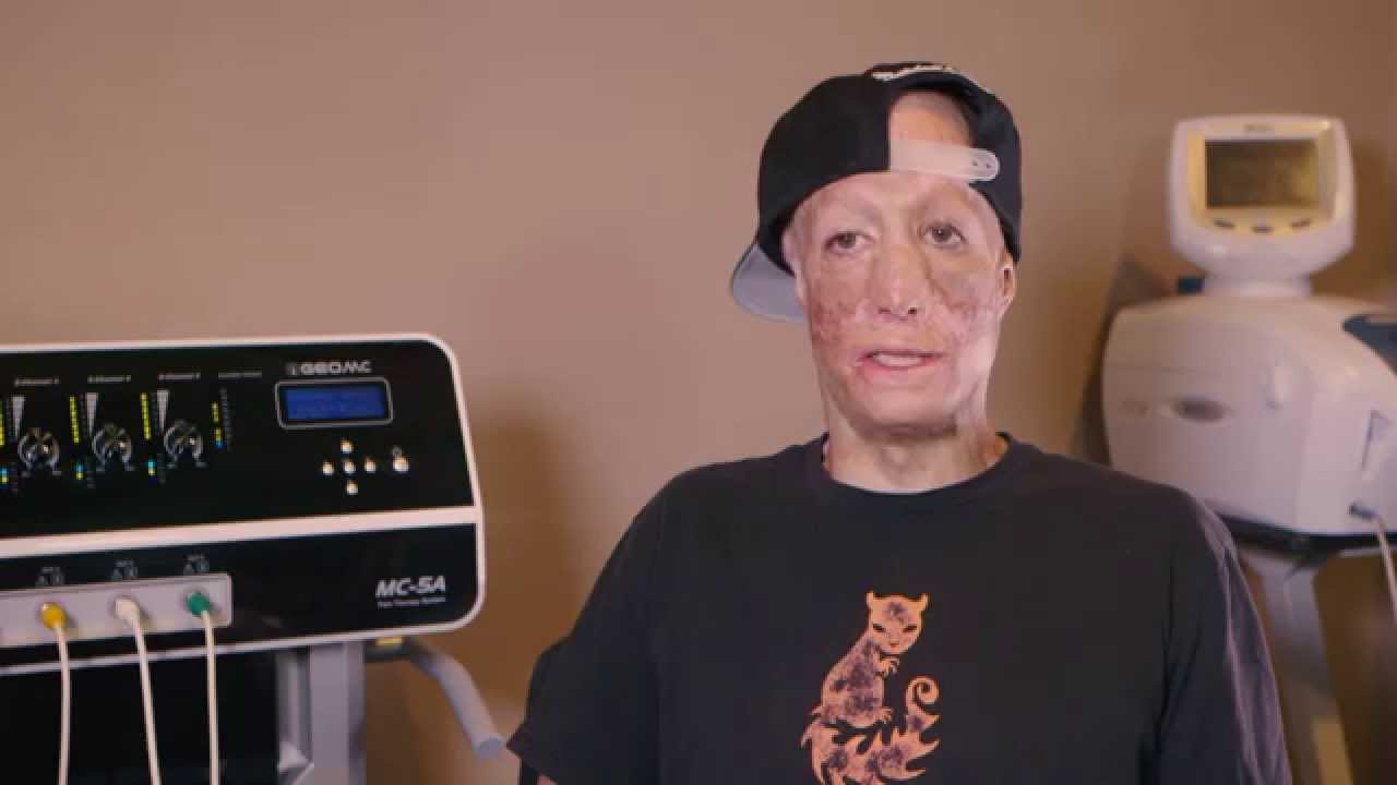 The Burn Survivor - Sollievo - Las Vegas - YouTube