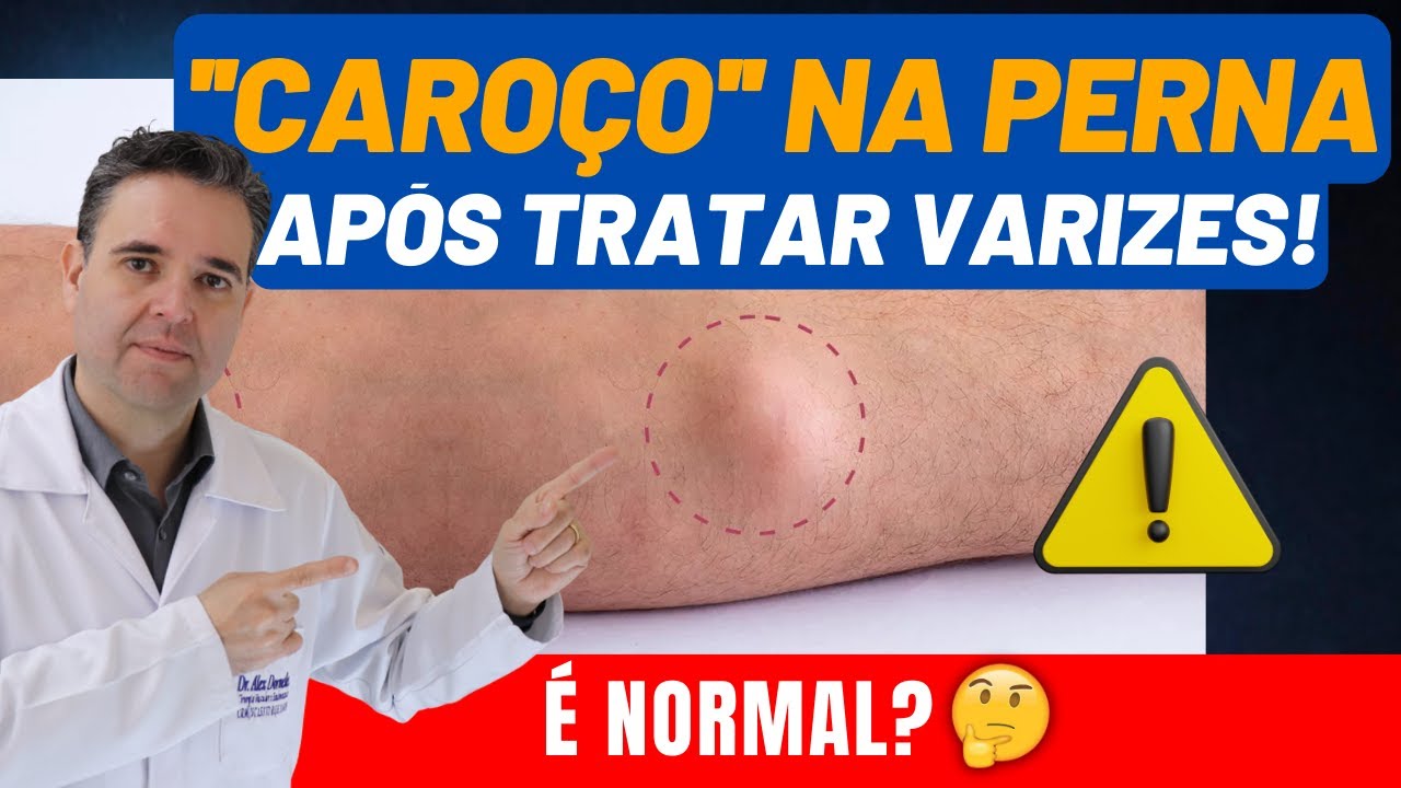 Nódulos na perna após a tratamento de varizes. Isso é normal? - Dr ...