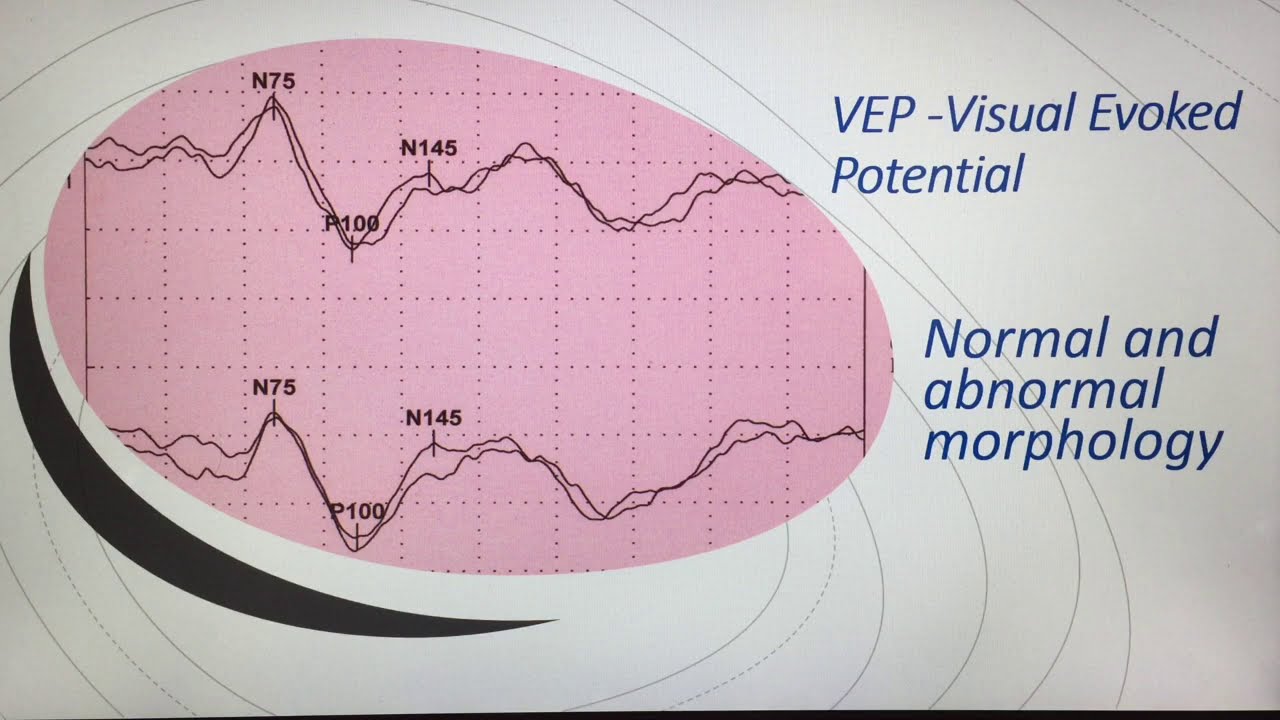 Visual Evoked Potential (VEP) - YouTube