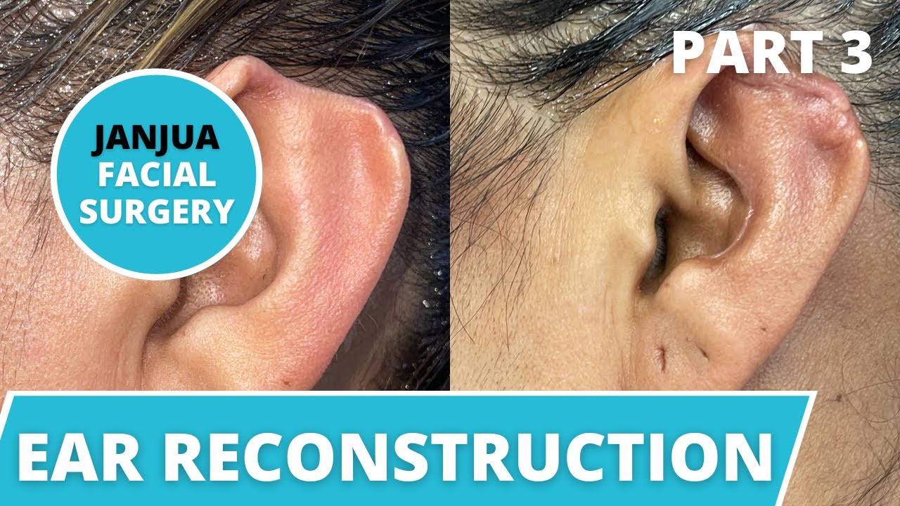 EAR RECONSTRUCTION SURGERY ON MISSING UPPER EAR | PART 3 - DR. TANVEER ...