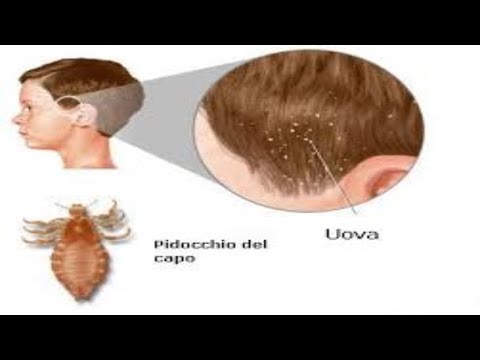Pidocchi e pediculosi: 6 cose da sapere - YouTube