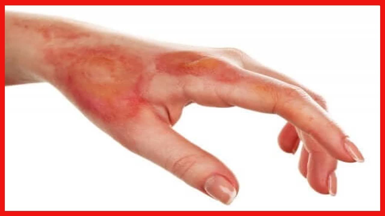 Diagnostic de la nécrose cutanée - YouTube