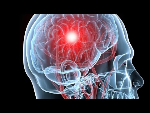 How to protect yourself from a stroke - YouTube