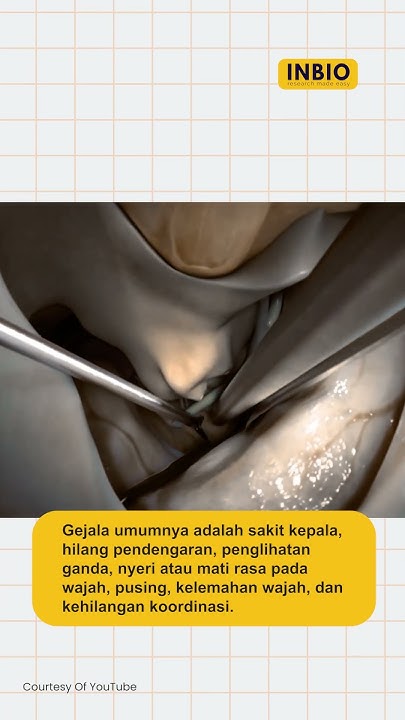 Proses pengangkatan tumor otak - YouTube