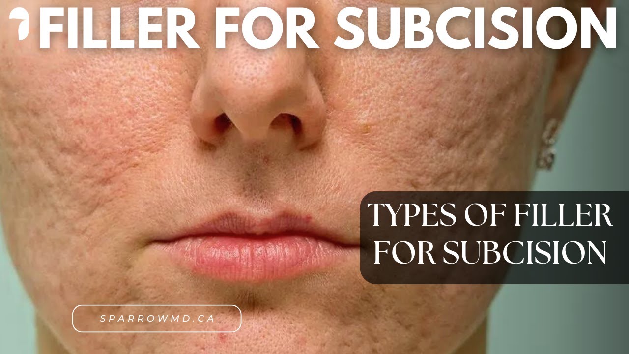 Types of Dermal Fillers For Subcision - YouTube