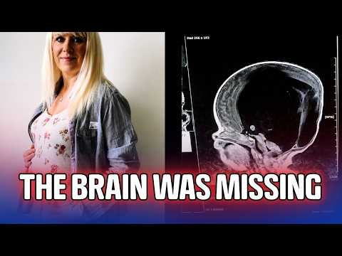 Baby Born With 2% of His Brain Survives | The Boy With No Brain
