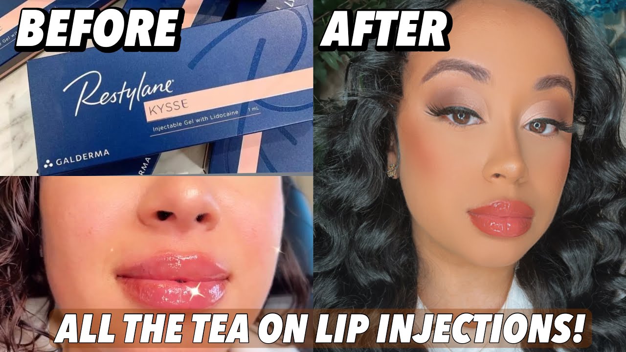 LIP FILLER VLOG! My First Time Getting Lip Injections + Healing Process ...