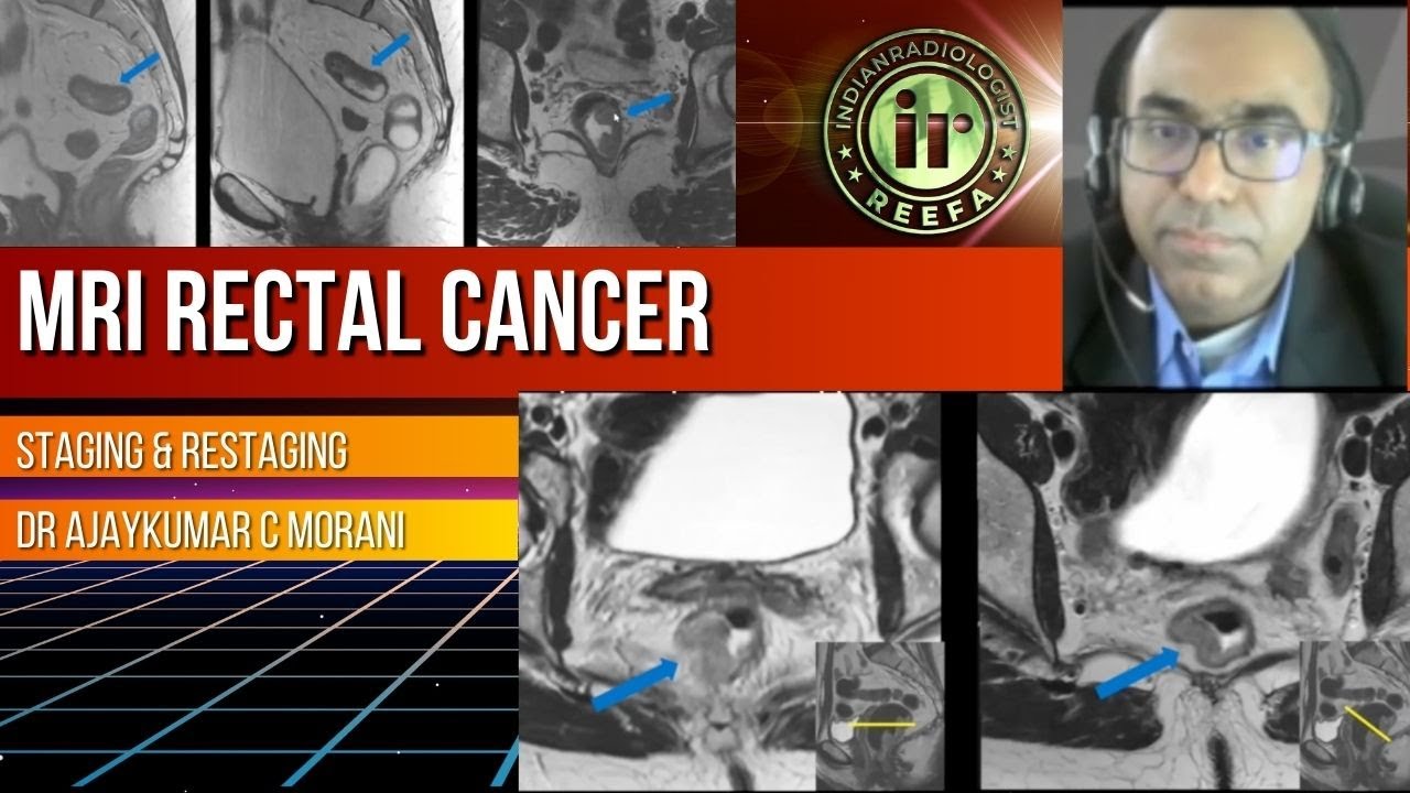ONCOIMAGING SPECIAL | DR AJAYKUMAR MORANI || MRI OF RECTAL CANCER ...