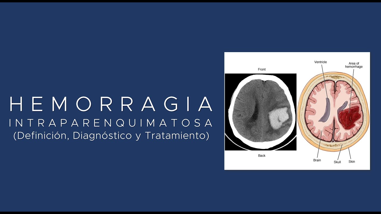 Hemorragia Intraparenquimatosa Vs Hemorragia Subaracnoidea