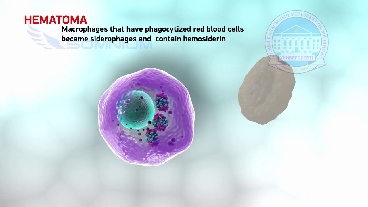 M048 Intracellular accumulation and deposition in the parenchyma and ...
